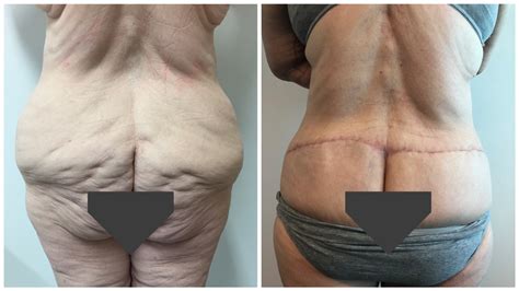 Buttocks Lift Before And After Dr Sawhney Sculpted Clinic
