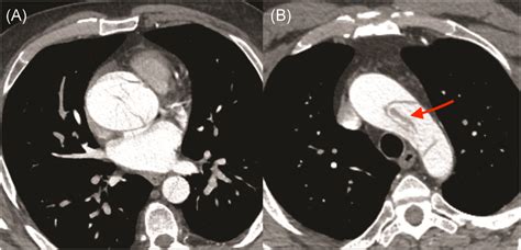 A Preoperative Ct Angiogram Demonstrating Dilated Aortic Root And