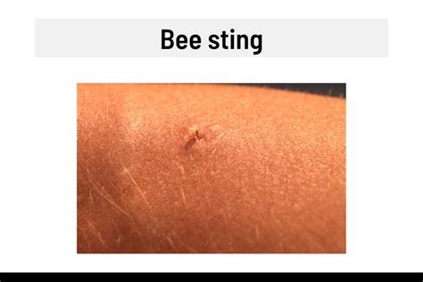 Why Did My Bee Sting Blister