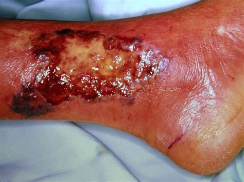 Early Pyoderma Gangrenosum