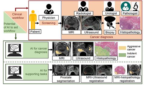 Indrani Bhattacharya Phd Imaging Based Prostate Cancer Detection