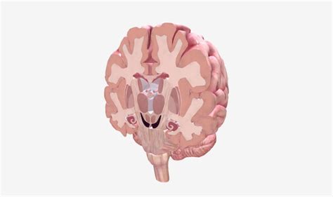 Premium Photo Multiple Sclerosis Lesions In Brain
