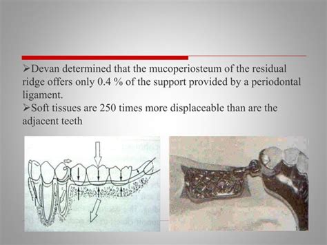 Designing For Kennedy Class I And Class Ii Ppt Oral Care Personal Care