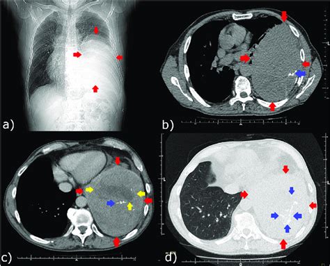 IMT Detected In A Male Patient A A Radiogram Presenting A Download Scientific Diagram