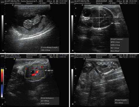 A The Crown Rump Length Crl Measurement In The Eighth Week Of Download Scientific Diagram
