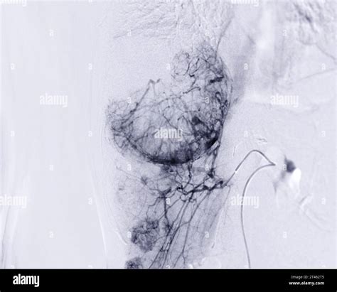 Transarterial Chemoembolization Tace Is A Medical Procedure Used To The Treatment Of