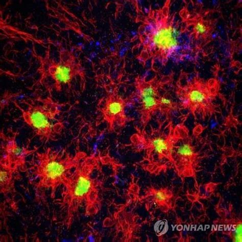 독일 연구진 치매 일으키는 알츠하이머병 씨앗 찾았다 연합뉴스