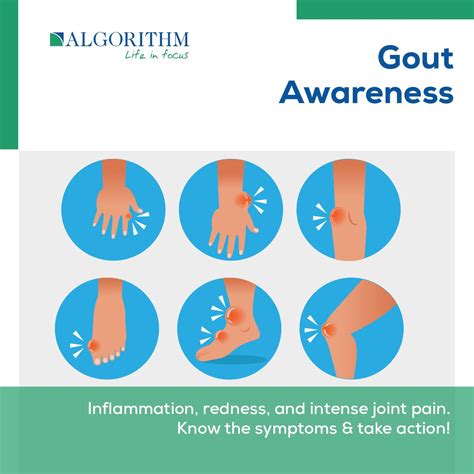 Algorithm Lifeinfocus Gout Goutawareness Algorithm Pharmaceutical