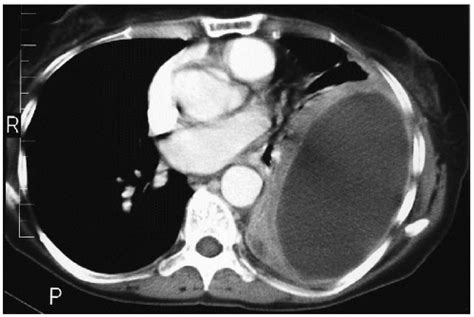 Empyema Thoracic Key