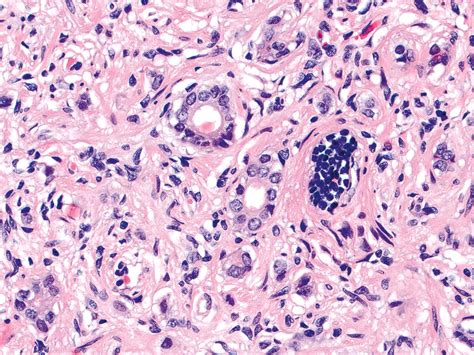 Neuroendocrine Tumors Of The Gastrointestinal And Pancreatobiliary Tracts Clinical Tree