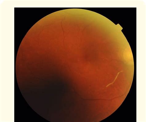 Same Embolus As In Figure 2 However With Loss Of Refractile