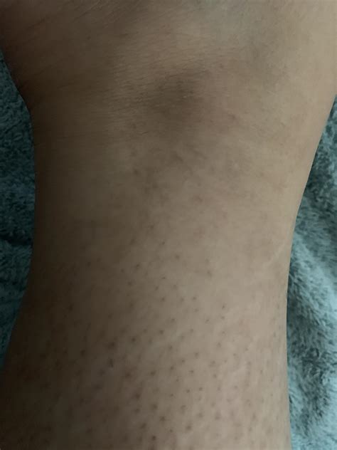Is There A Way To Get Rid Of These Dots They Appear Even After I Shave Can I Exfoliate Them