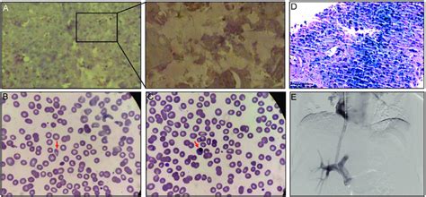 Bone Marrow Blood And Liver Biopsy Specimens A Bone Marrow Biopsy