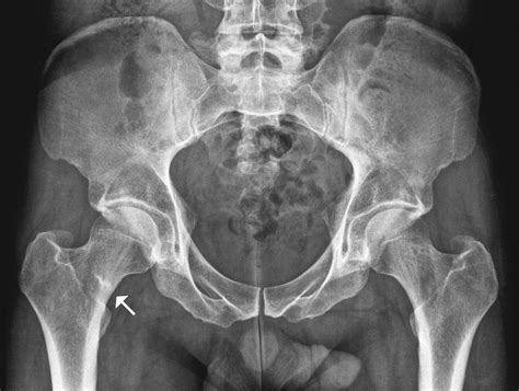 Compression Fracture X Ray Femur
