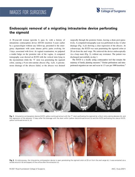 Pdf Endoscopic Removal Of A Migrating Intrauterine Device Perforating The Sigmoid
