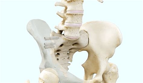 Understanding Si Joint Dysfunction And Minimally Invasive Fusion