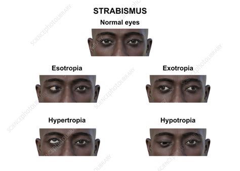 Man With Various Strabismus Types Illustration Stock Image F042