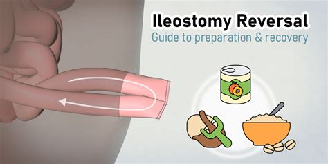 Patient Learning Ileostomy Reversal Tvasurg The Toronto Video Atlas Of Surgery