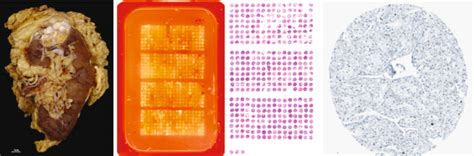 Tissue Microarray Analysis Tma Primary Tissue Samples Are Taken From