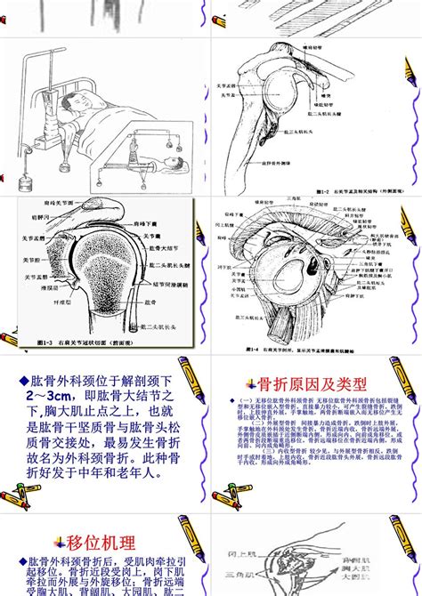 肱骨骨折PPT 卡卡办公