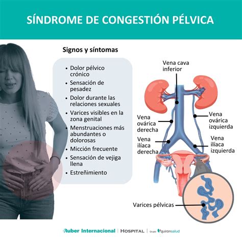 Tratamiento De Varices Pélvicas Con Embolización Técnica Mínimamente Invasiva