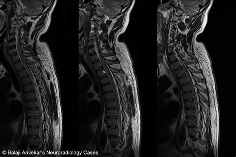 The Spinal Cord Mri Of The Spinal Cord