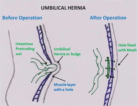 Umbilical Hernia In Adults After Pregnancies Pin On Health And Wellness