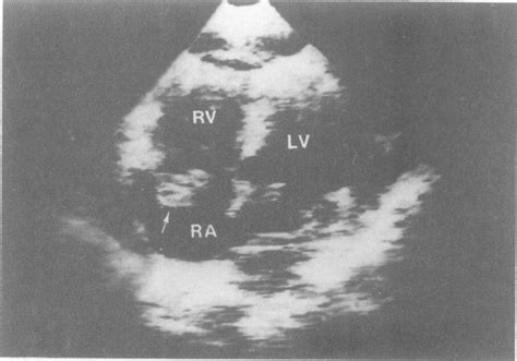 Case 3 Two Dimensional Echo Showing Large Free Floating Thrombus Download Scientific Diagram