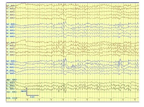 Eeg Variants With Patterns By Murtaza Syed