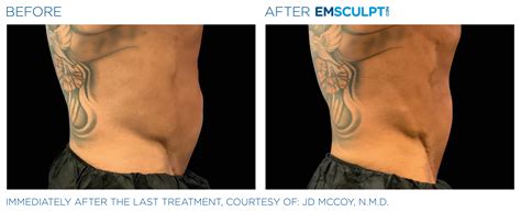 Emsculpt Neo More Muscle Less Fat — Rejuve Medspa Newcastle Near