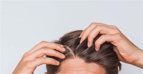 How To Treat Hair And Scalp Conditions Healthy Mens
