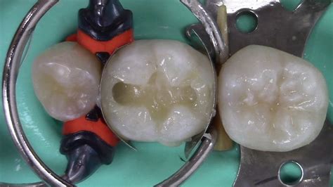 Class Ii Composite Restoration Youtube Class Ii Composite Restoration Youtube