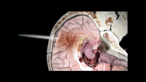 What Is A Craniectomy Youtube