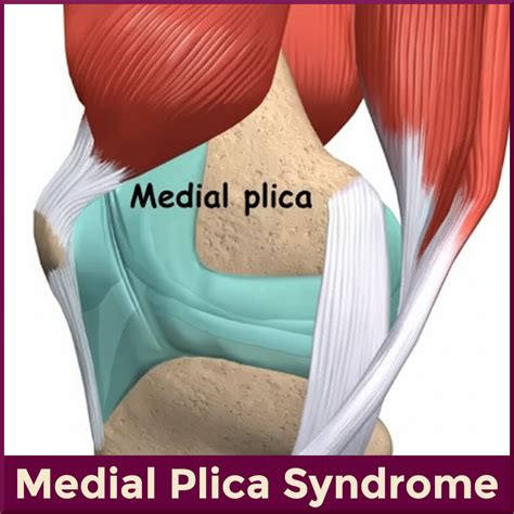 Medial Plica Syndrome Sports Med Review
