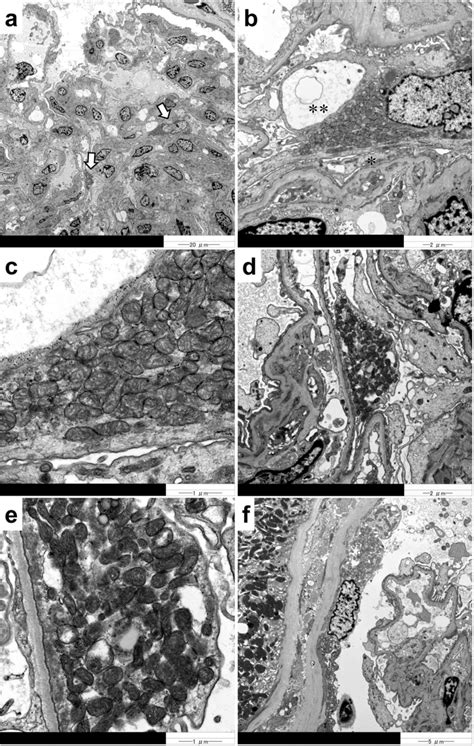 Electron Microscopy Findings A Arrows Indicate Podocytes Filled With
