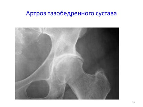 Заболевания бедра и тазобедренного сустава Клиника диагностика лечение презентация онлайн