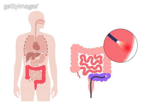 Sigmoidoscopy Medical Procedure 이미지 1681436776 게티이미지뱅크