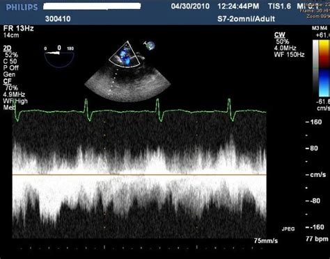 Cw Doppler In Patient With Asd And Mild Left To Right Shunt Download Scientific Diagram