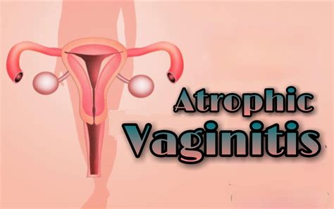 Atrophic Vaginitis Symptoms And Causes