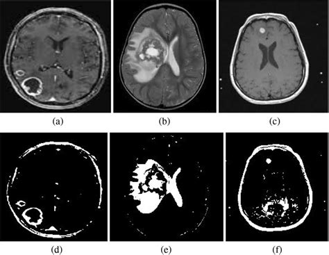 Workflow Of The Svm Based Classifier For Brain Tumor Detection A Download Scientific Diagram