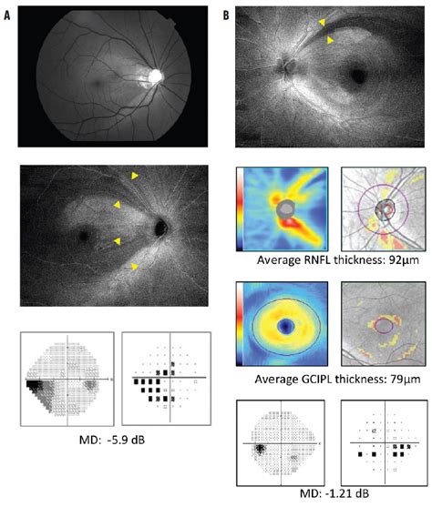 Retinal Nerve Fiber Layer Optical Texture Analysis Hku Ophthalmology