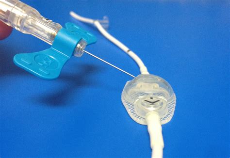 Subcutaneous Butterfly Catheter At Dawn Lovelace Blog