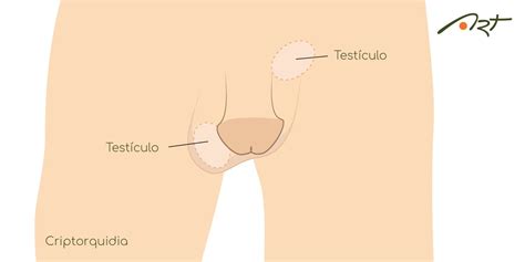 Criptorquidia Diagnóstico Art Medicina Reprodutiva