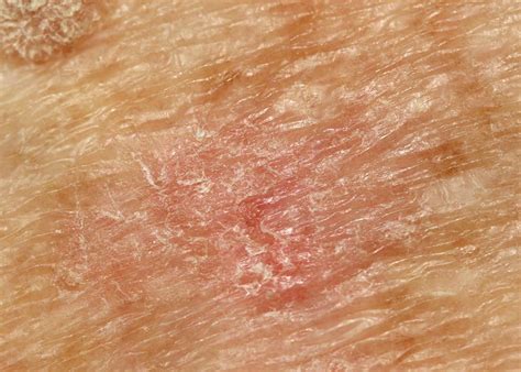 Dangers Of Actinic Keratosis Is Actinic Keratosis Dangerous Tcddlx