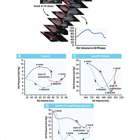 Ra Volume Measurement And Example Ra Pv Loops Download Scientific Diagram