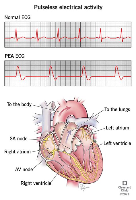 Pulseless Electrical Activity Pea Causes And Treatment Acls Hot Sex