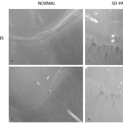 Pdf An Evaluation Of Two Novel Capillaroscopy Techniques In Suspected
