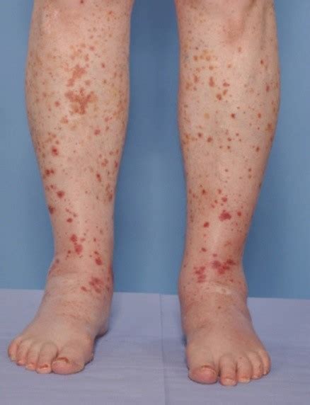 Komplikasi Vaskulitis Yang Membawa Parah Cetus