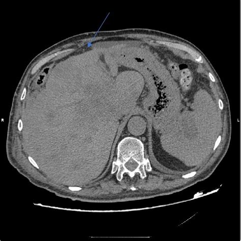 Ct Scan Showing Diffuse Hypodense Metastatic Nodules In The Liver And Download Scientific