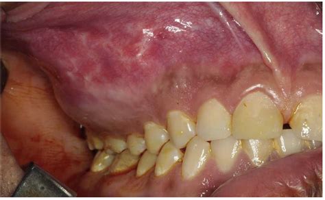 Fibrous Dysplasia Focus Dentistry